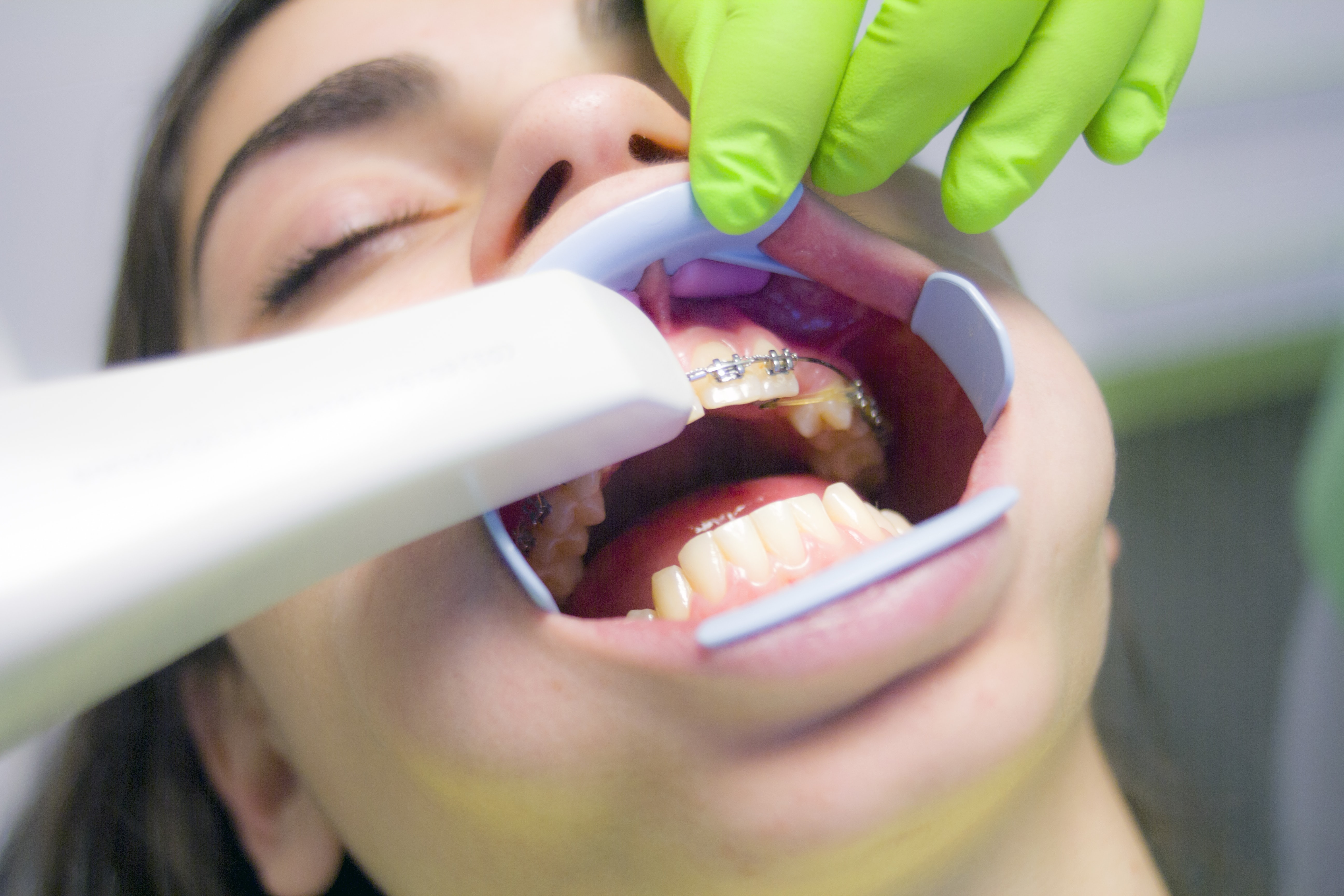 Invisalign Vs Braces Comparing Two Orthodontic Options Kneib